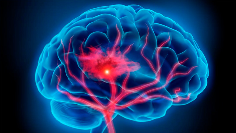 Qué es un mini ACV y cómo identificar los síntomas para actuar rápido ...